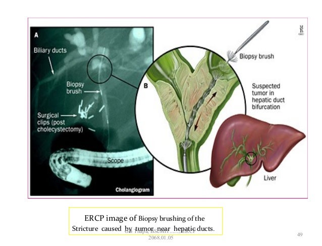 ERCP PROCEDURE