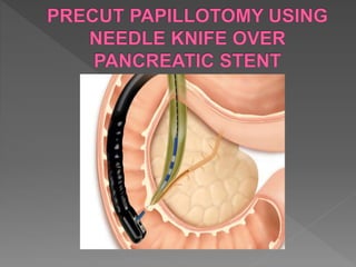 Ercp- for Beginners | PPTX