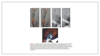 Endoscopic Retrograde Cholangiopancreatography (ERCP): overview and ...
