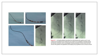 Endoscopic Retrograde Cholangiopancreatography (ERCP): overview and ...