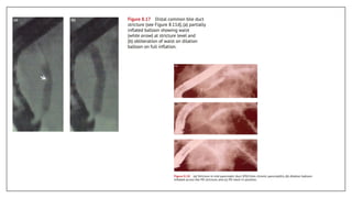 Endoscopic Retrograde Cholangiopancreatography (ERCP): overview and ...