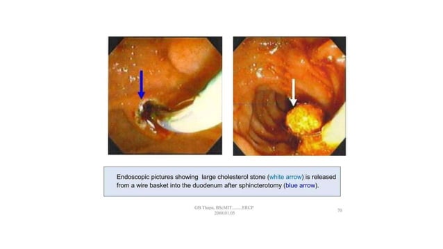 ERCP (1).pptx
