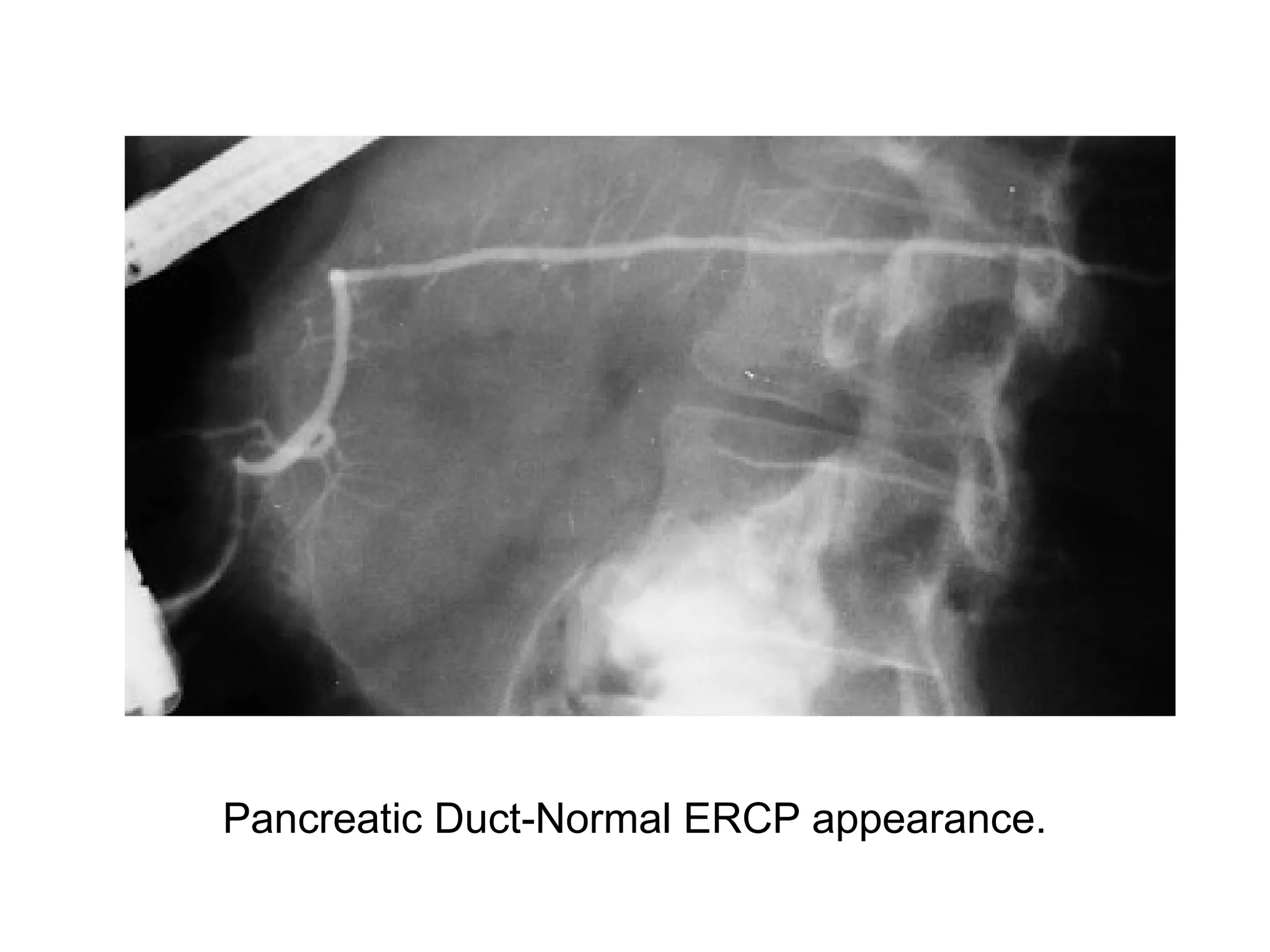 Endoscopic Retrograde Cholangiopancreatography .pptx
