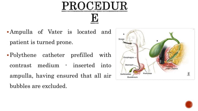 (ERCP) Cholangiopancreatography Bile ducts procedure | PPTX | Digestive ...