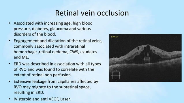 Exudative Retinal Detachment | PPTX