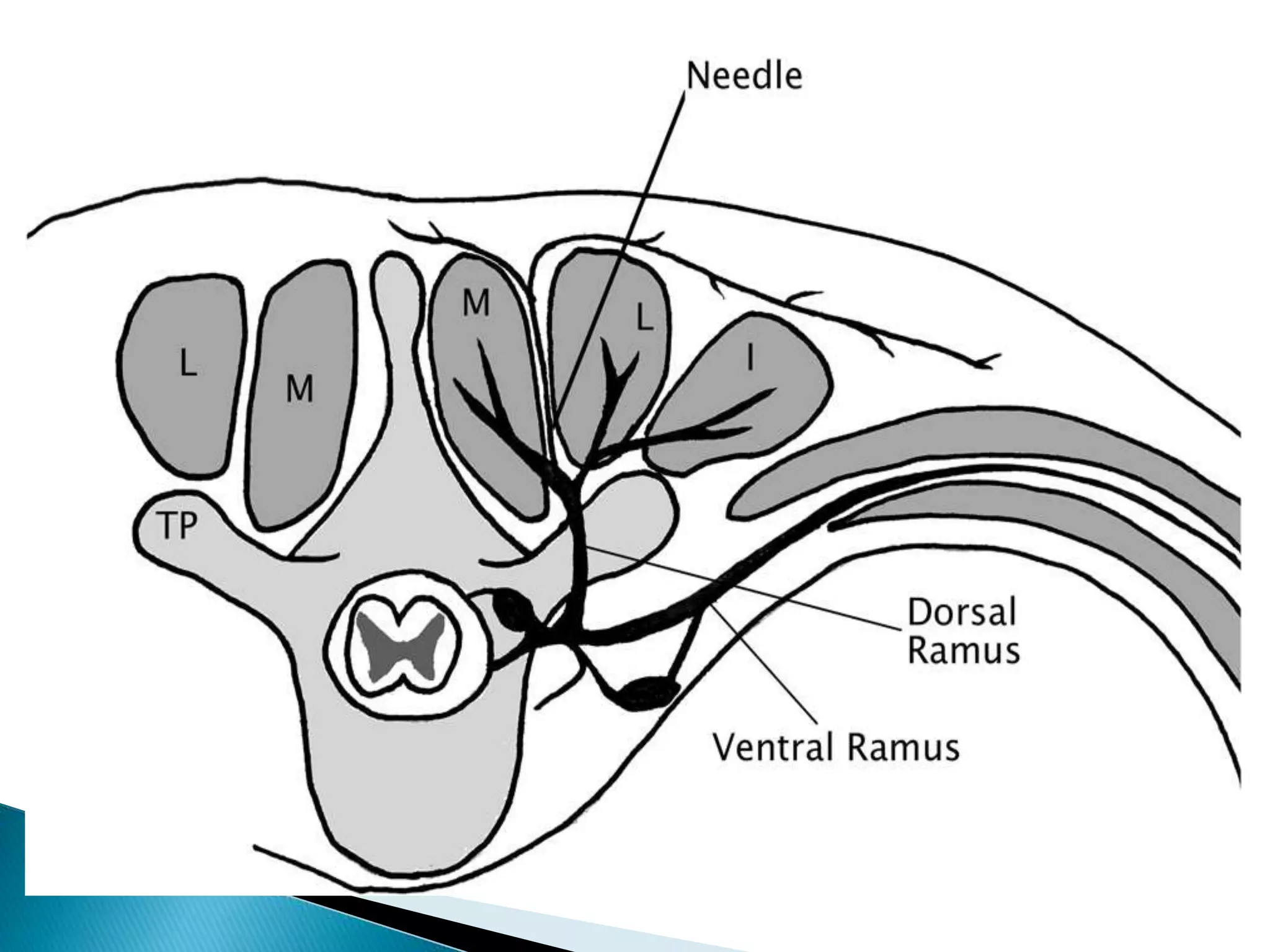 Erector spinae plane block for pain management | PPTX