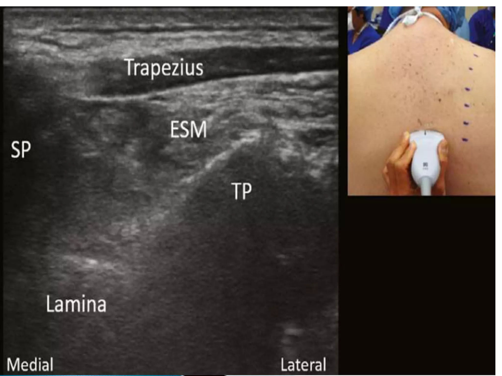 Erector spinae plane block for pain management | PPTX