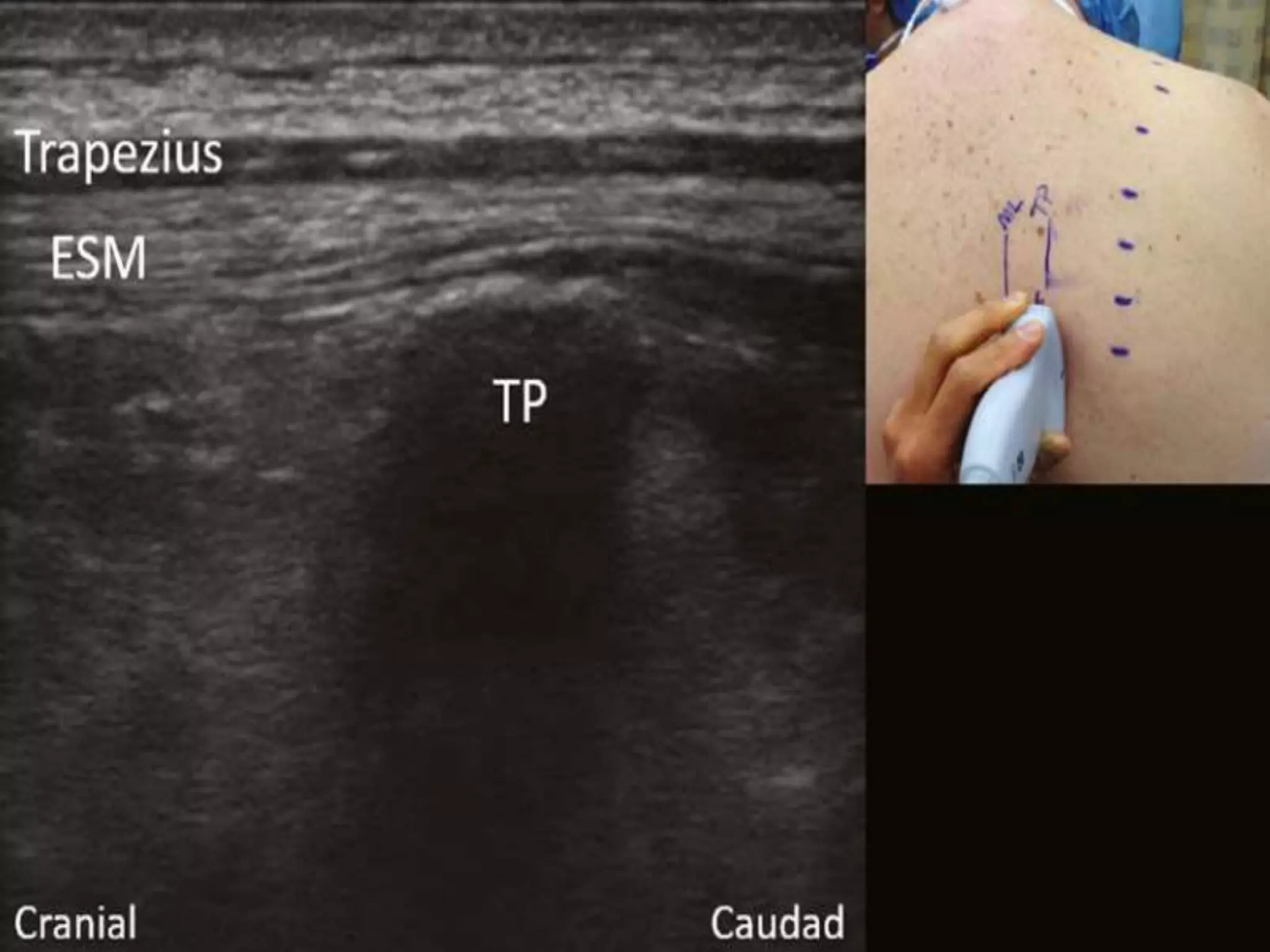 Erector spinae plane block for pain management | PPTX
