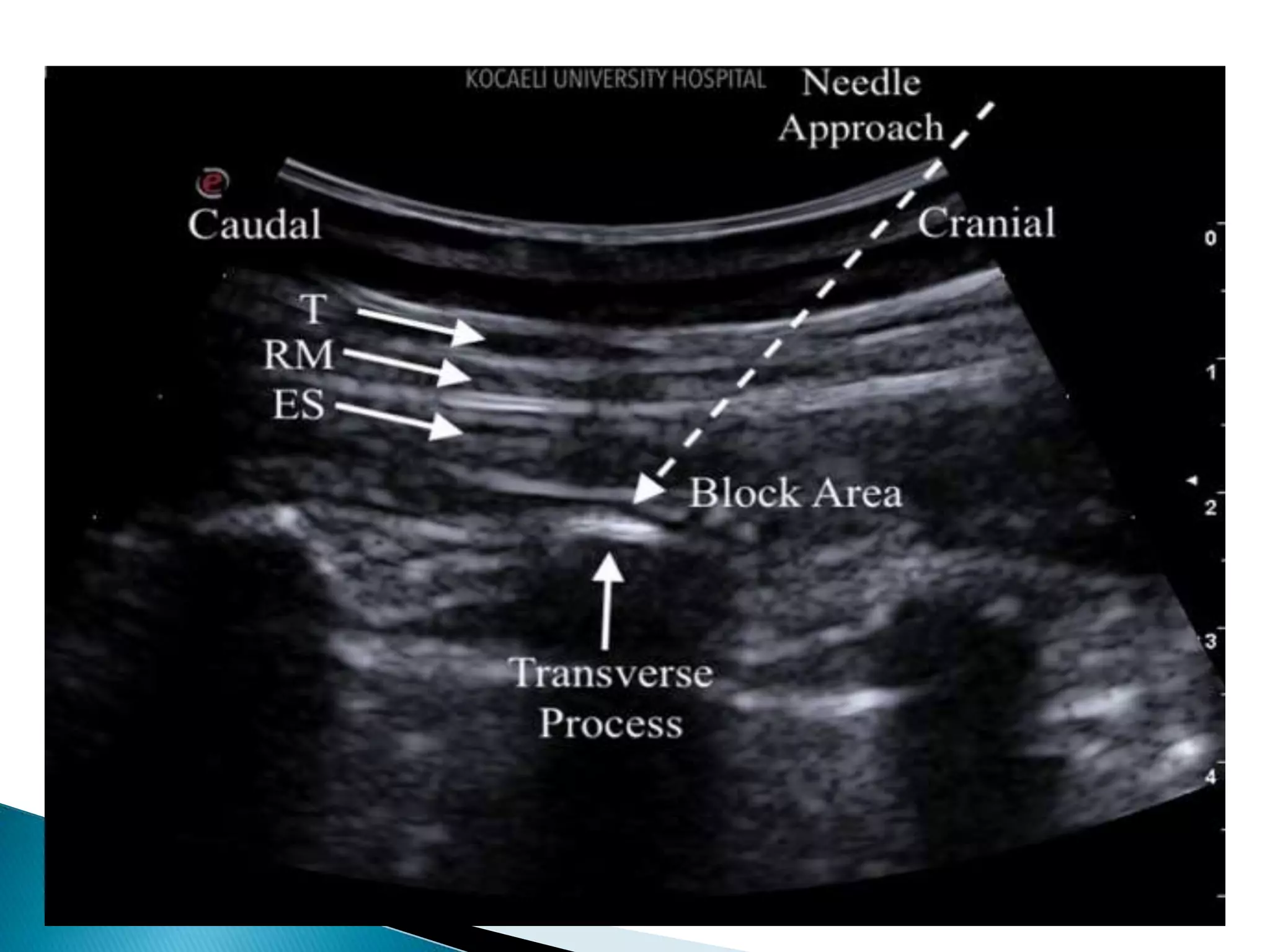 Erector spinae plane block for pain management | PPTX