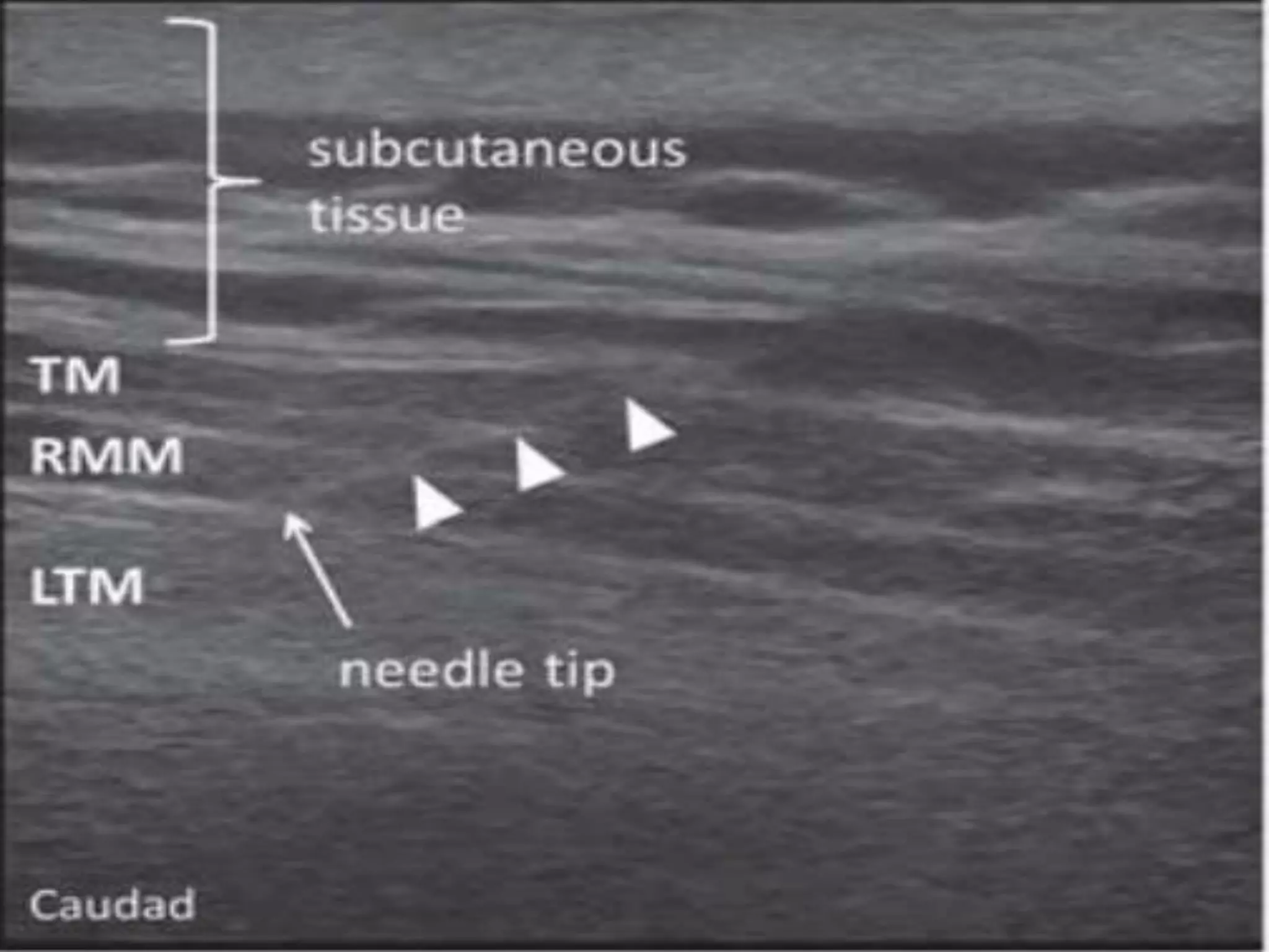 Erector spinae plane block for pain management | PPTX