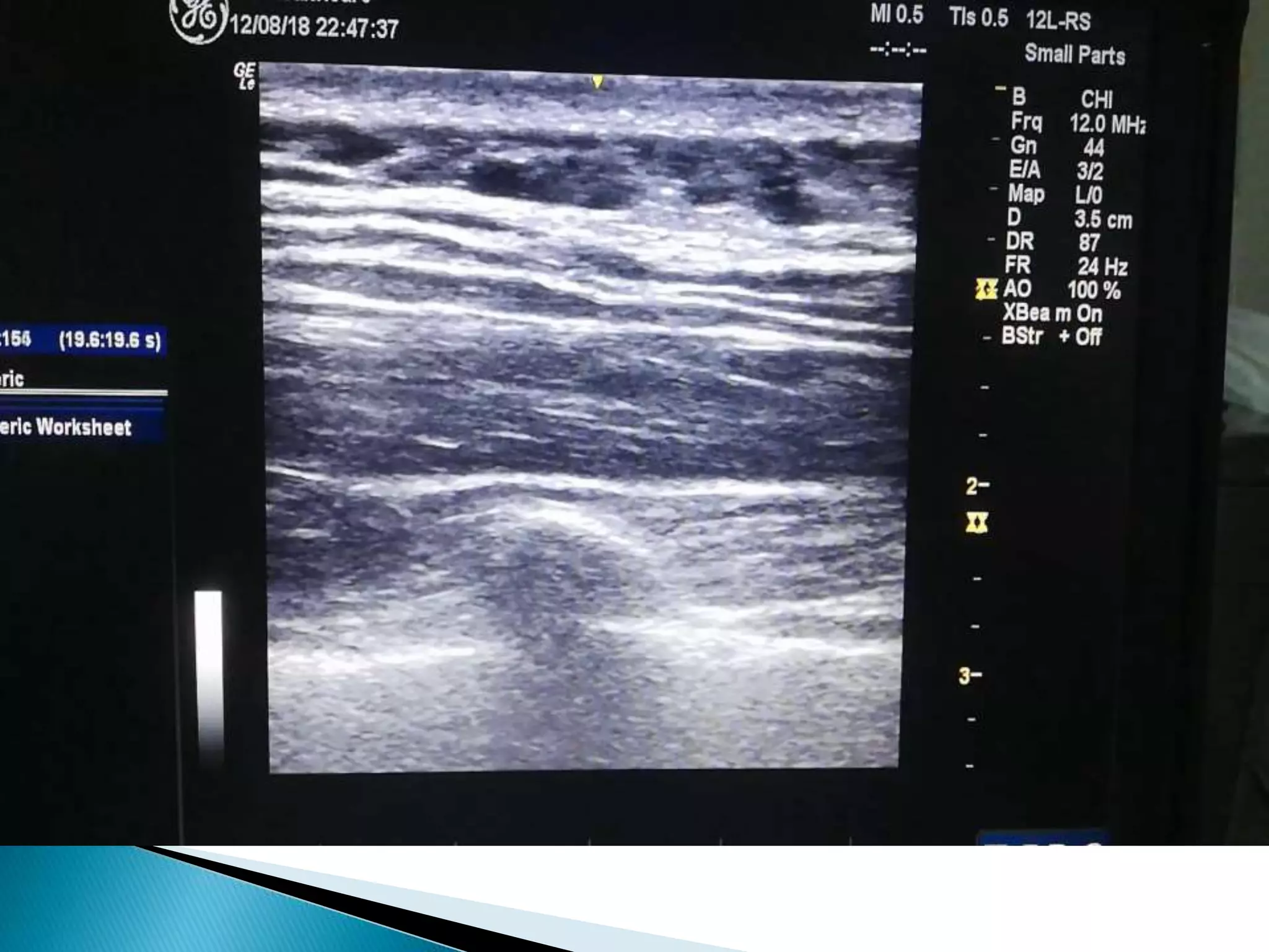 Erector spinae plane block for pain management | PPTX