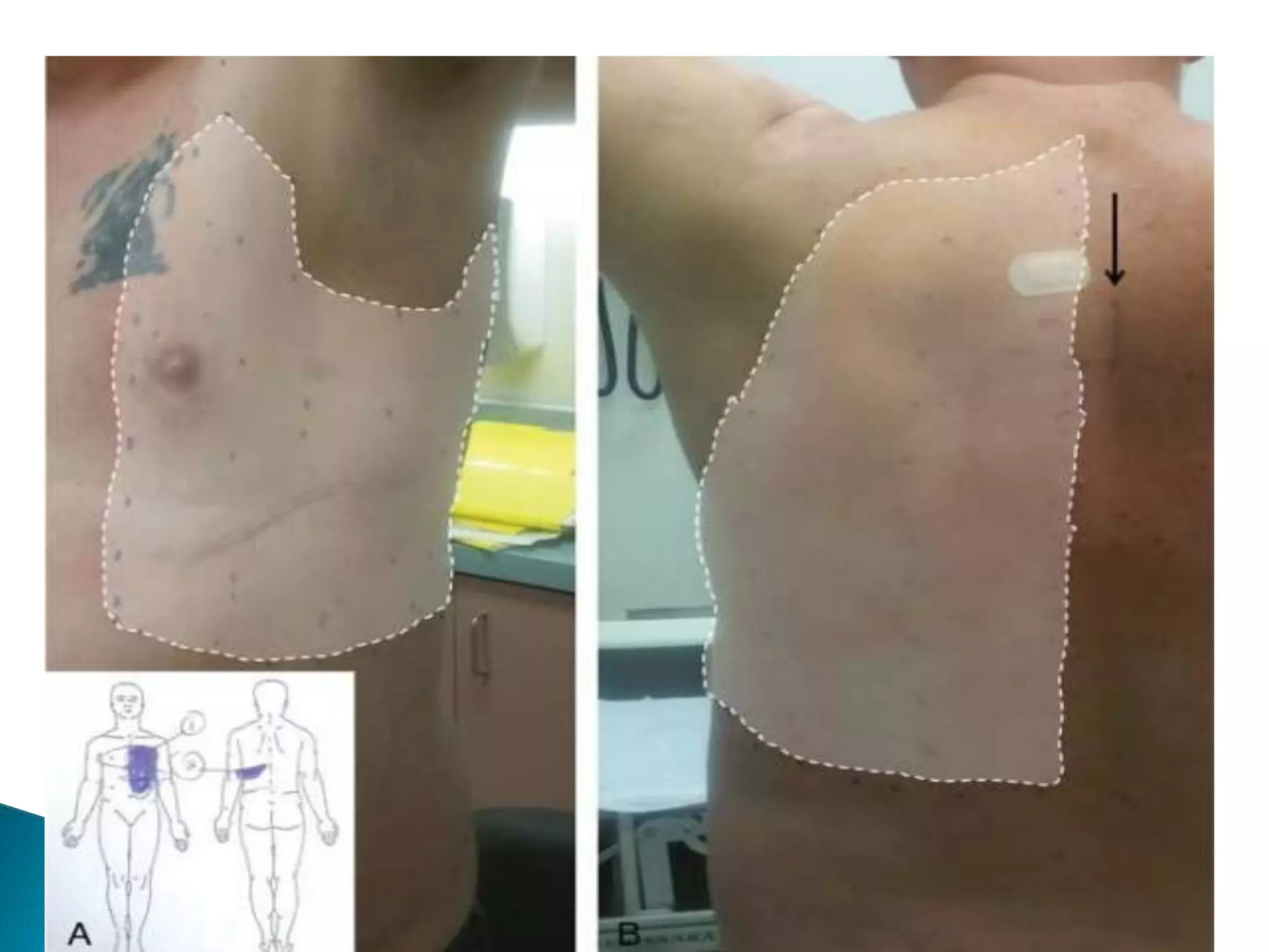 Erector spinae plane block for pain management | PPTX