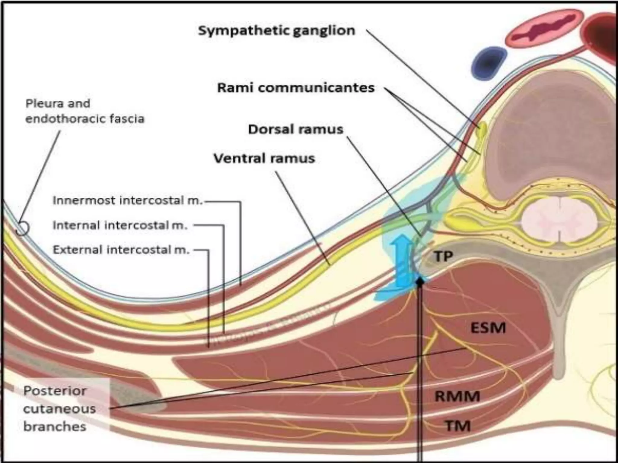 Erector spinae plane block for pain management | PPTX