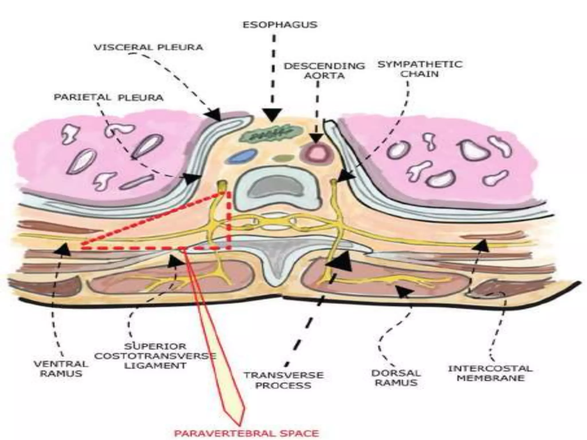 Erector spinae plane block for pain management | PPTX