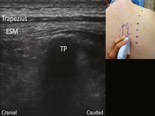 Erector spinae plane block for pain management | PPTX