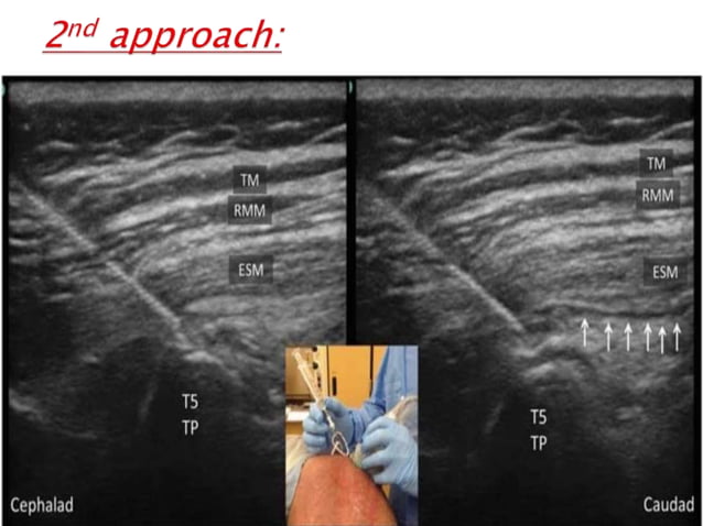 Erector spinae plane block for pain management | PPTX