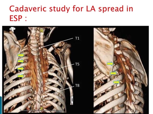 Erector spinae plane block for pain management | PPTX