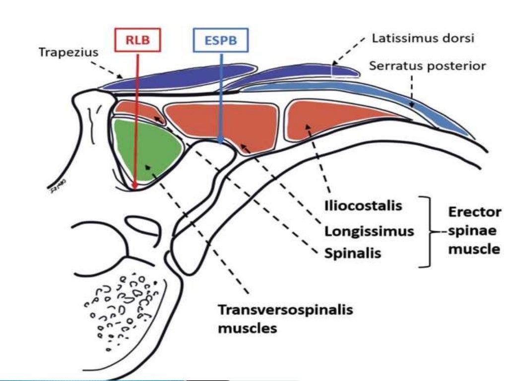 Erector spinae plane block for pain management
