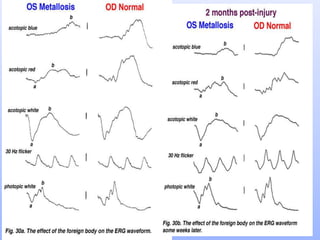 Electrophysiology (ERG and EOG) Simplified........ | PPTX