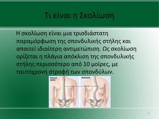 Ergasia skoliosi iek | PPT