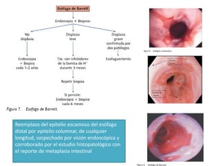 ENFERMEDAD POR REFLUJO GASTROESOFAGICO | PPTX