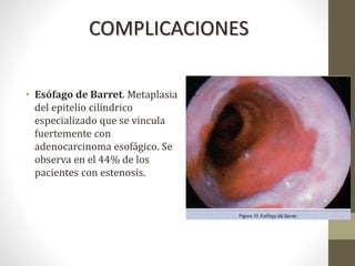 ENFERMEDAD POR REFLUJO GASTROESOFAGICO (ERGE) | PPTX