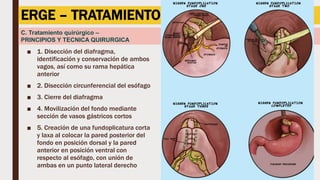 TRASTORNOS DE LA MOTILIDAD DEL ESOFAGO | PPTX | Ear, Nose and Throat ...