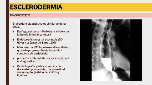TRASTORNOS DE LA MOTILIDAD DEL ESOFAGO