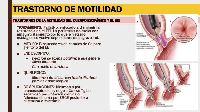 TRASTORNOS DE LA MOTILIDAD DEL ESOFAGO