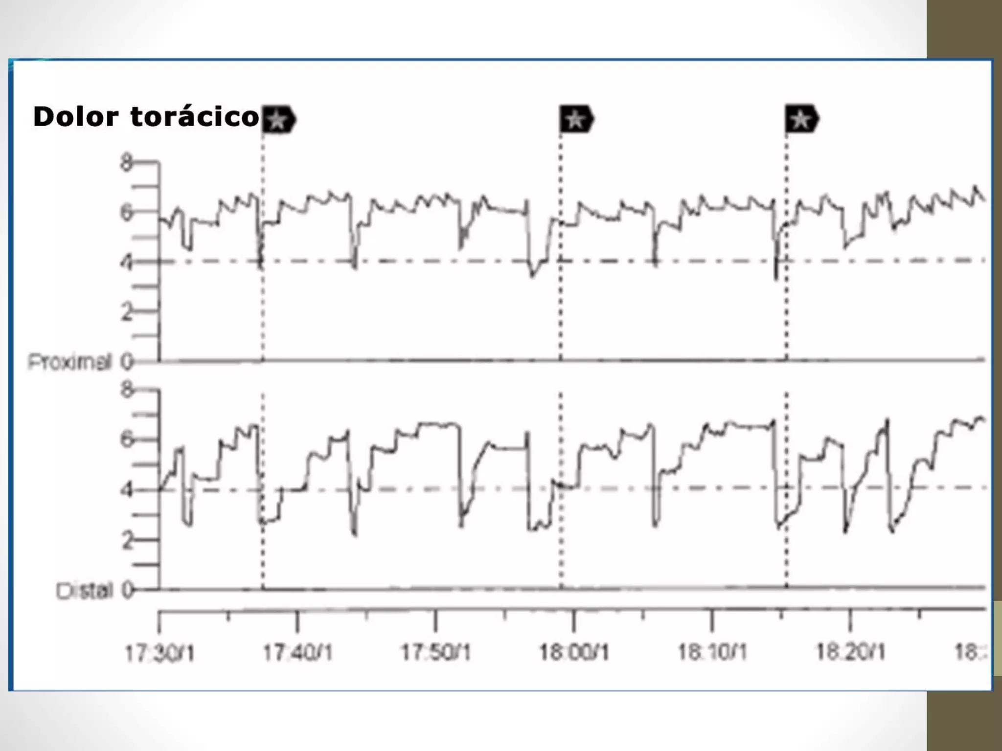 ERGE. Consenso de Lyon