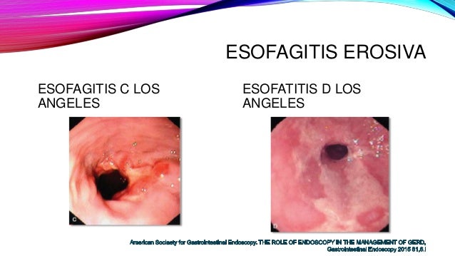 Enfermedad por reflujo gastroesofagico
