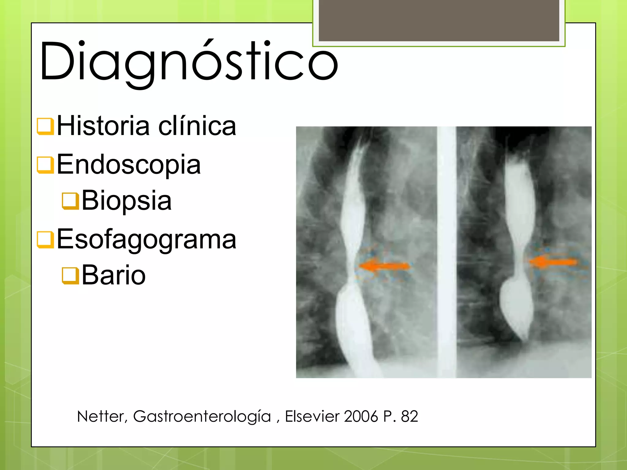 Erge,Estenosis Esofágica, Esofagitis, y quemadoruas del Esófago | PPTX