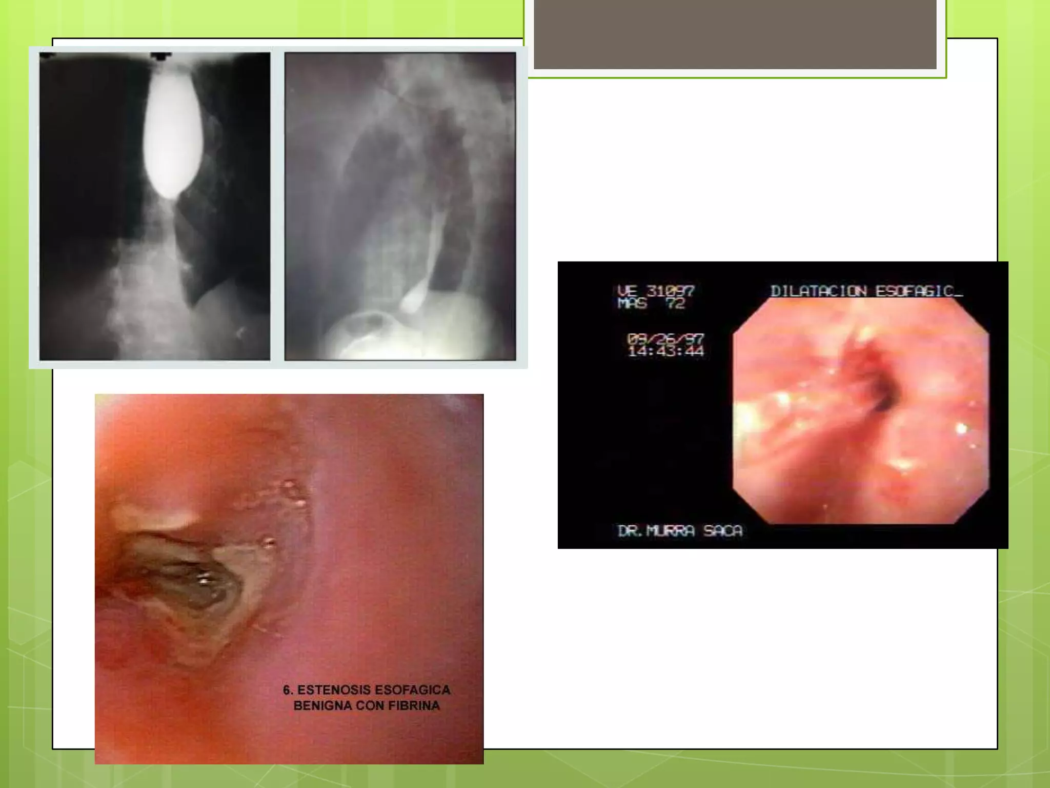 Erge,Estenosis Esofágica, Esofagitis, y quemadoruas del Esófago | PPTX