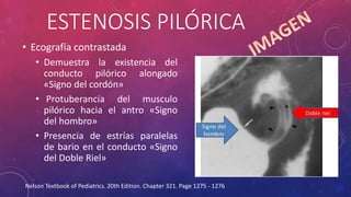 ERGE vs estenosis pilórica | PPTX