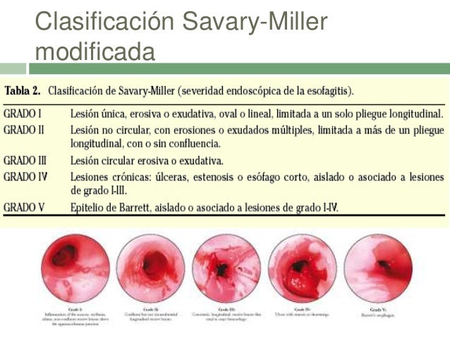 Erge y hernia hiatal