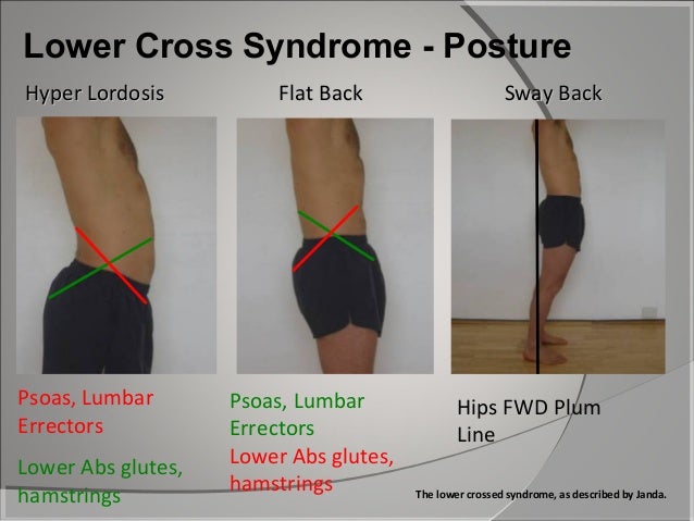 Vladimir Janda Upper Cross Syndrome Dr. Bryon's Health Blog: Upper