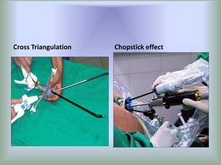 Ergonomics in laparoscopic surgery | PPTX
