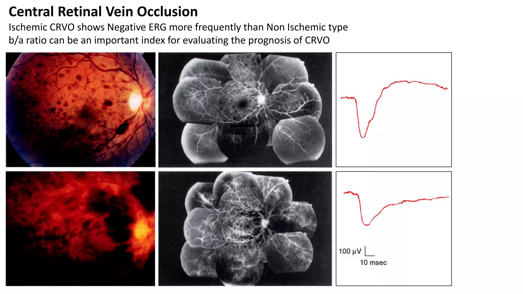 Electroretinogram and Clinical Applications | PPTX
