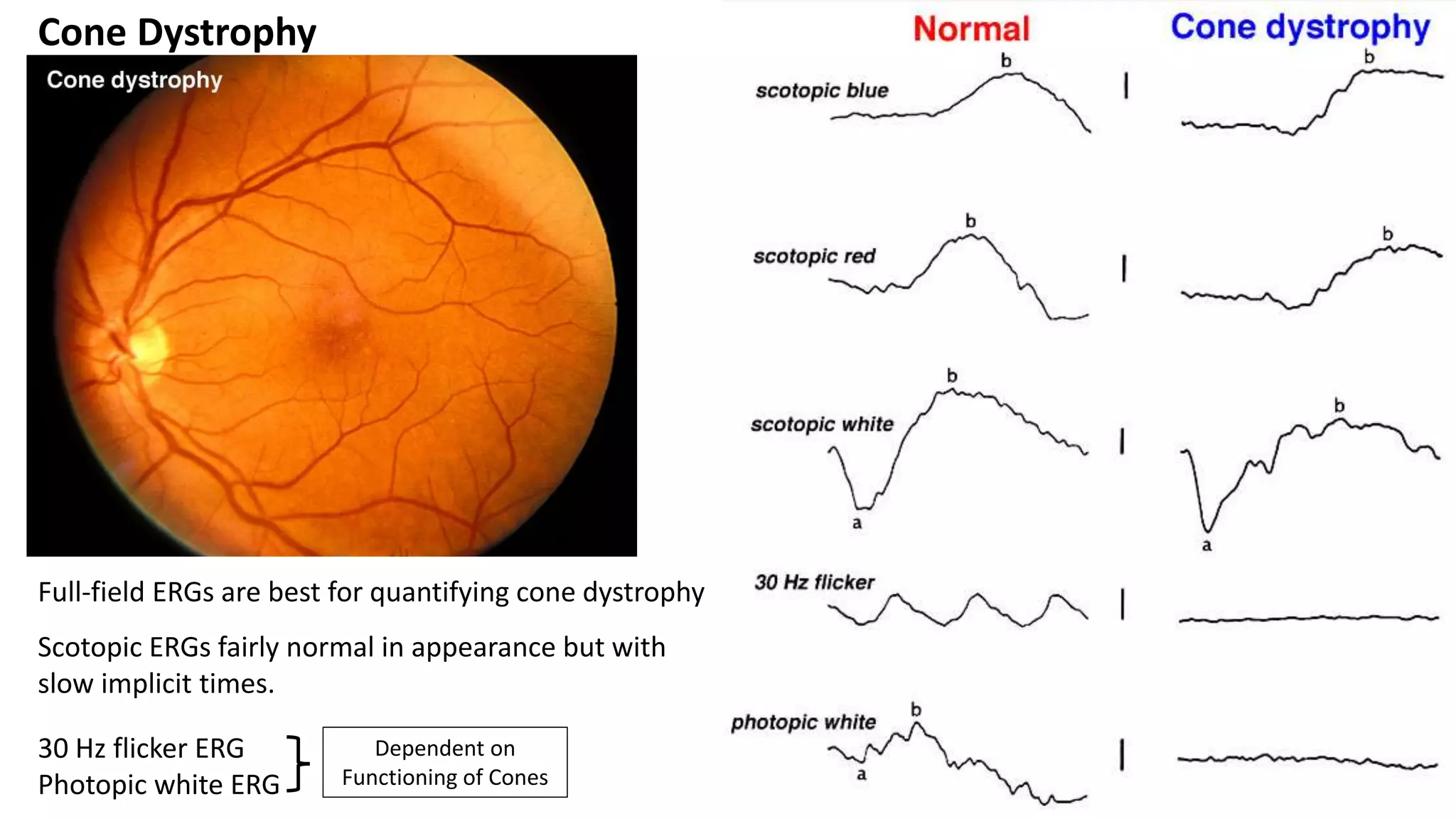 Electroretinogram and Clinical Applications | PPTX | Eye and Vision ...