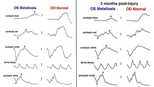 Electroretinogram and Clinical Applications | PPTX | Eye and Vision ...