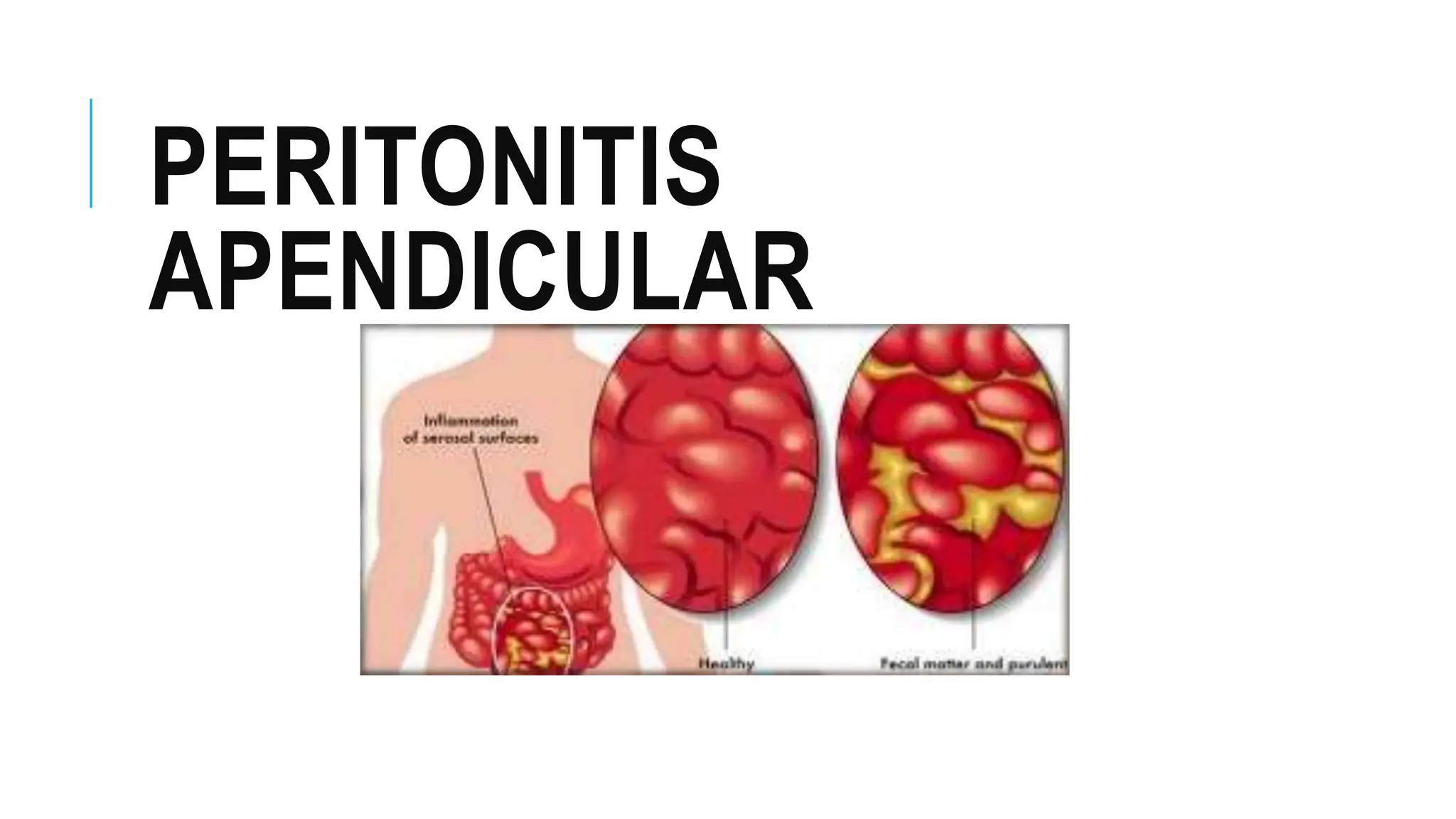 PERITONITIS LOCALIZADA Y GENERALIZADA, CIRUGIA GENERAL | PPT