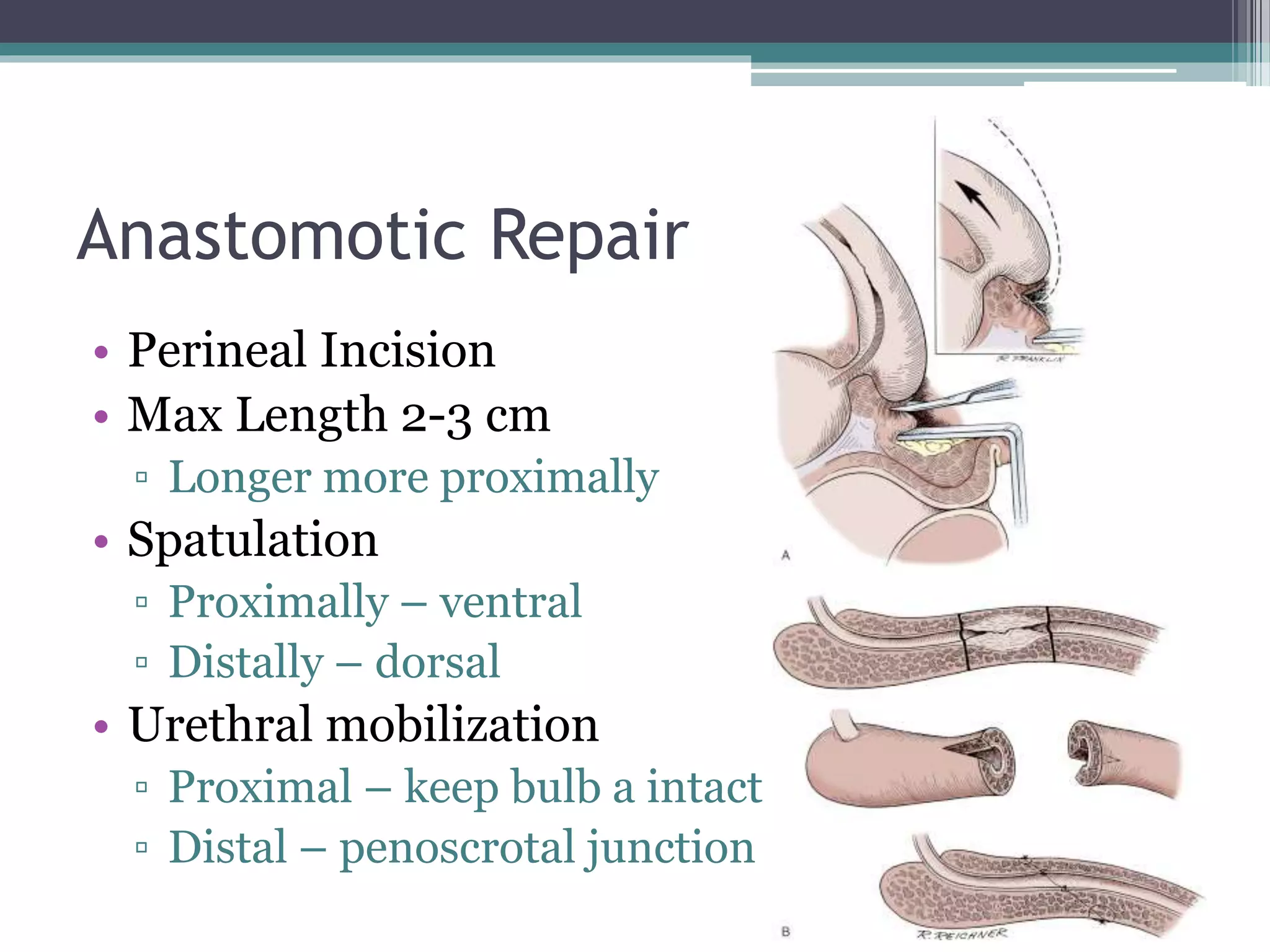 urethroplasty | PPTX
