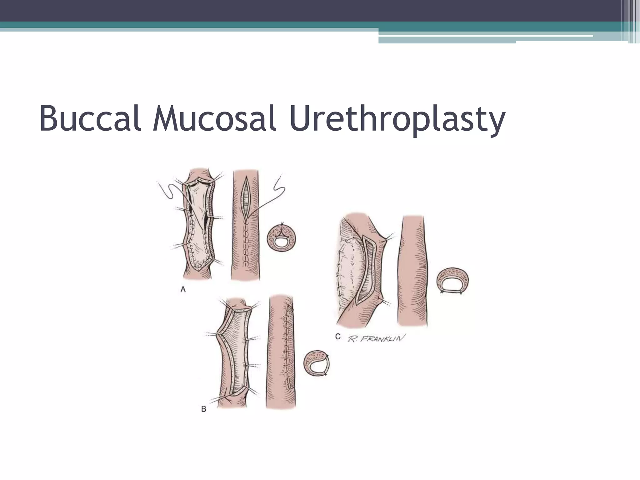urethroplasty | PPTX | Medical Health