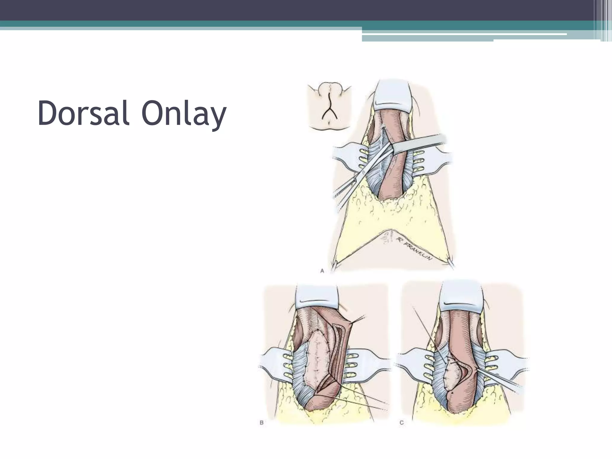 urethroplasty | PPTX