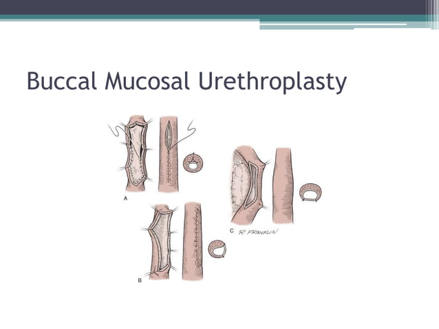 urethroplasty | PPTX | Medical Health