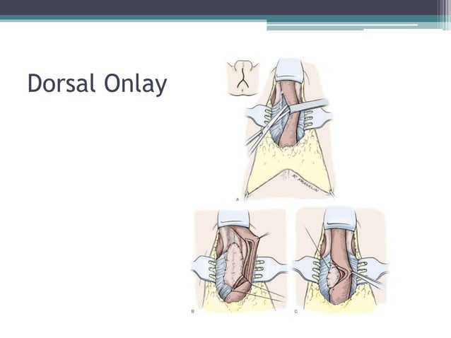 urethroplasty | PPTX | Medical Health