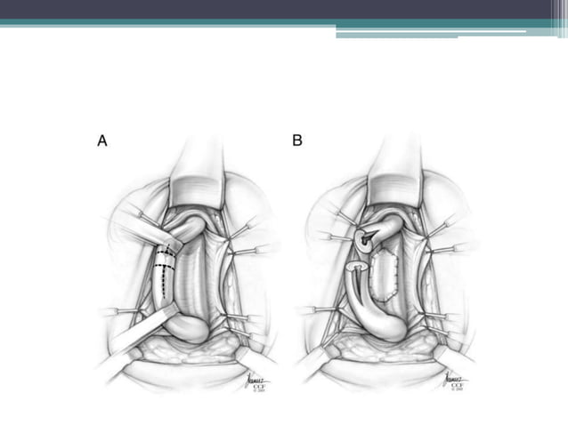 urethroplasty | PPTX | Medical Health