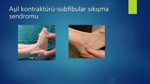 Eri̇şki̇n edi̇ni̇lmi̇ş düz taban deformi̇tesi̇ | PPT