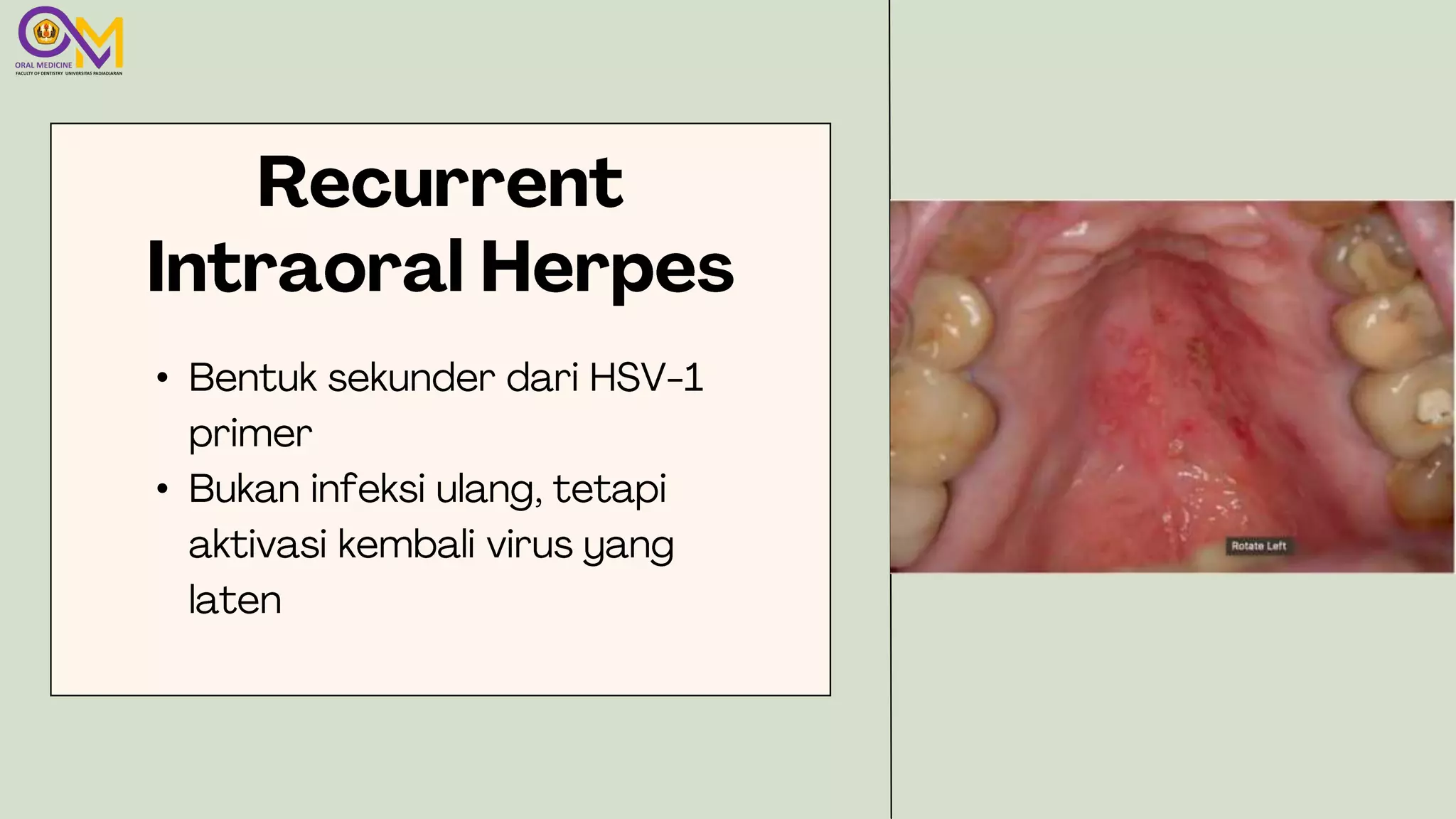 Eris Nurul Rahmadhini - 160721220004 - Recurrent Intraoral Herpes ...