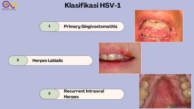 Eris Nurul Rahmadhini - 160721220004 - Recurrent Intraoral Herpes ...